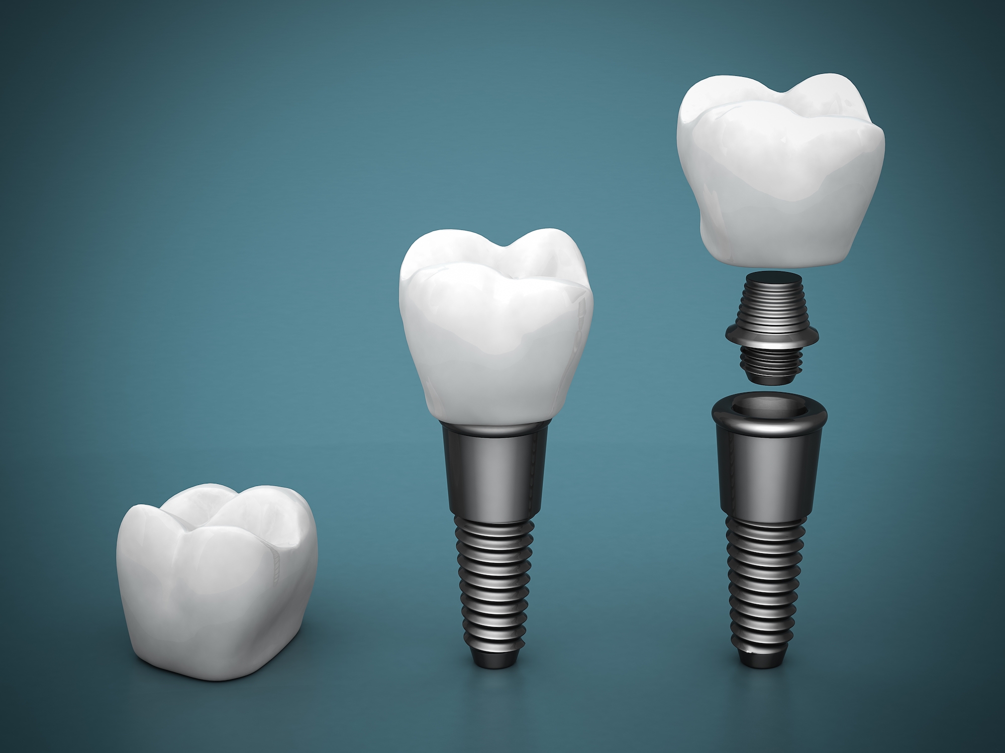Qu est ce Qu un Implant Dentaire Clinica Dentaria Campos Eliseos Qu est ce Qu un Implant Dentaire Clinica Dentaria Campos Eliseos